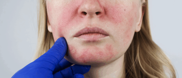 Reduce Facial Redness Naturally: Proven Tips That Work | Adore Skin Clinic